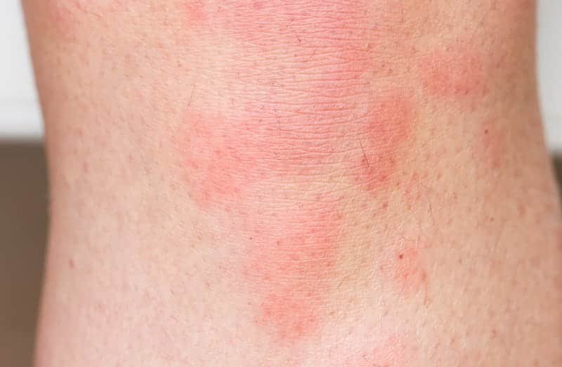 Orticaria da stress: sintomi, cause, durata e rimedi naturali - Auxilia ...